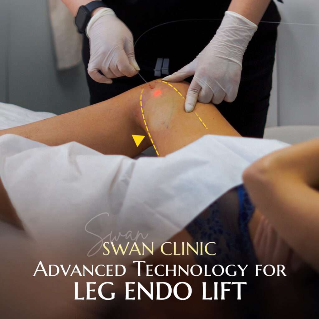 Leg Endolift in Dubai with Forza Laser Technology – The Modern Path to ...
