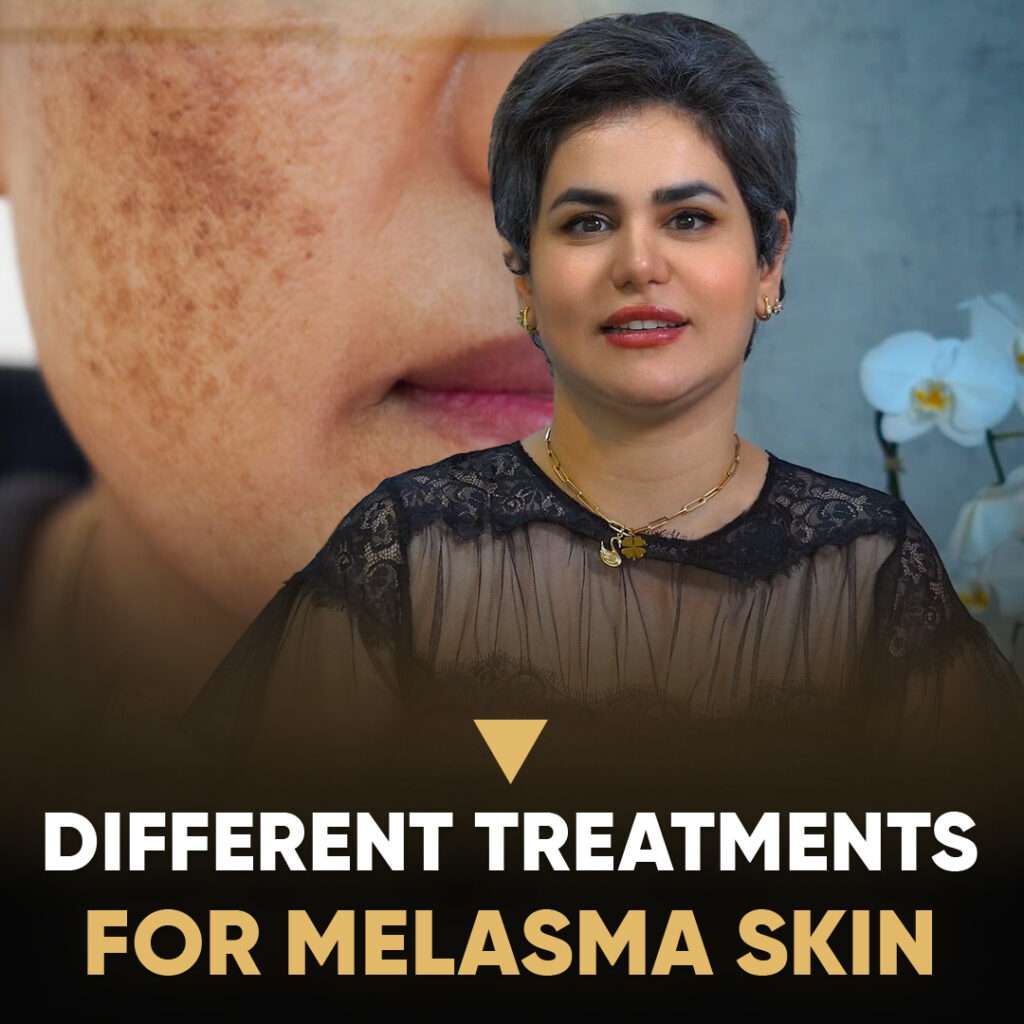 Melasma Treatments in Dubai – Gentle, Effective Solutions at Swan ...